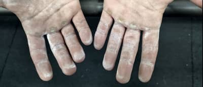 Does Chalk Bulletproof From Calluses?